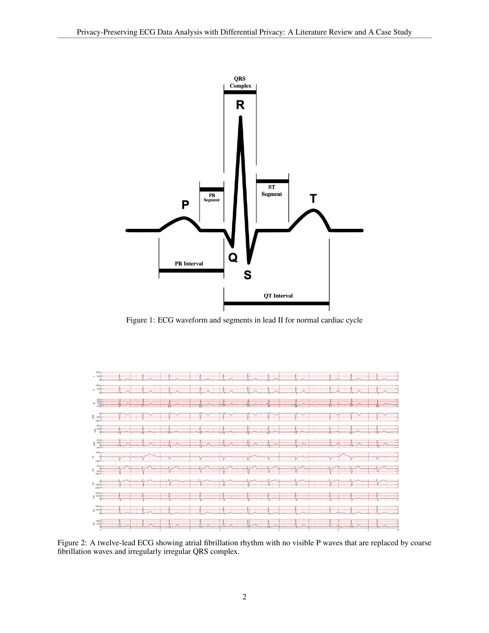 Privacy-Preserving ECG Data Analysis with Differential Privacy: A ...